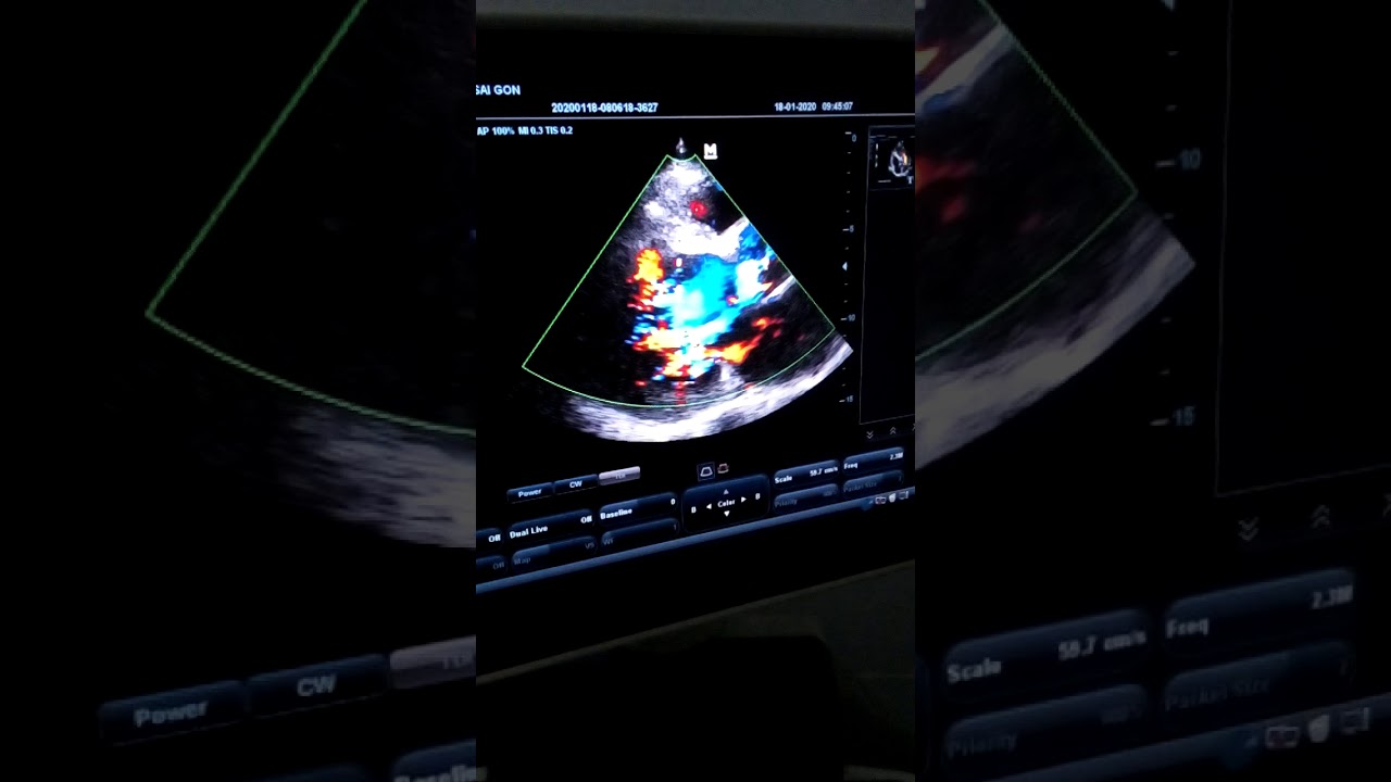 DCM echocardiography - YouTube