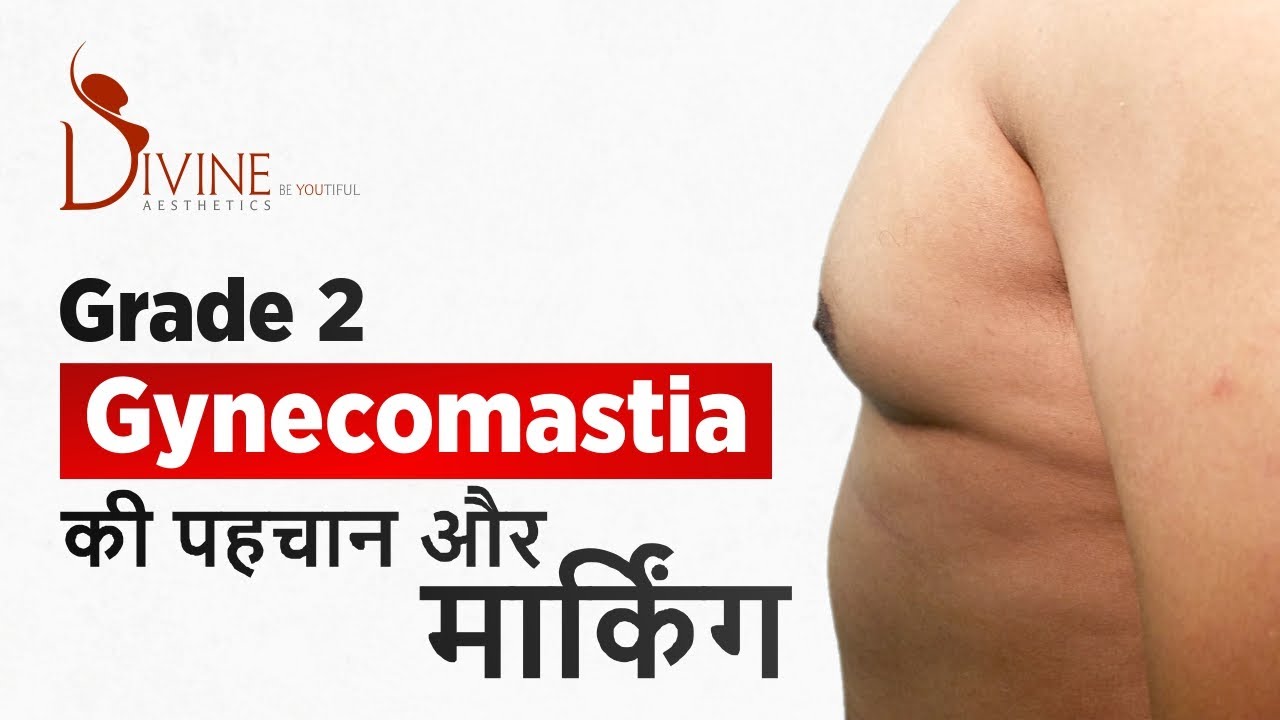 Grade 2 Gynecomastia की पहचान और मार्किंग - YouTube