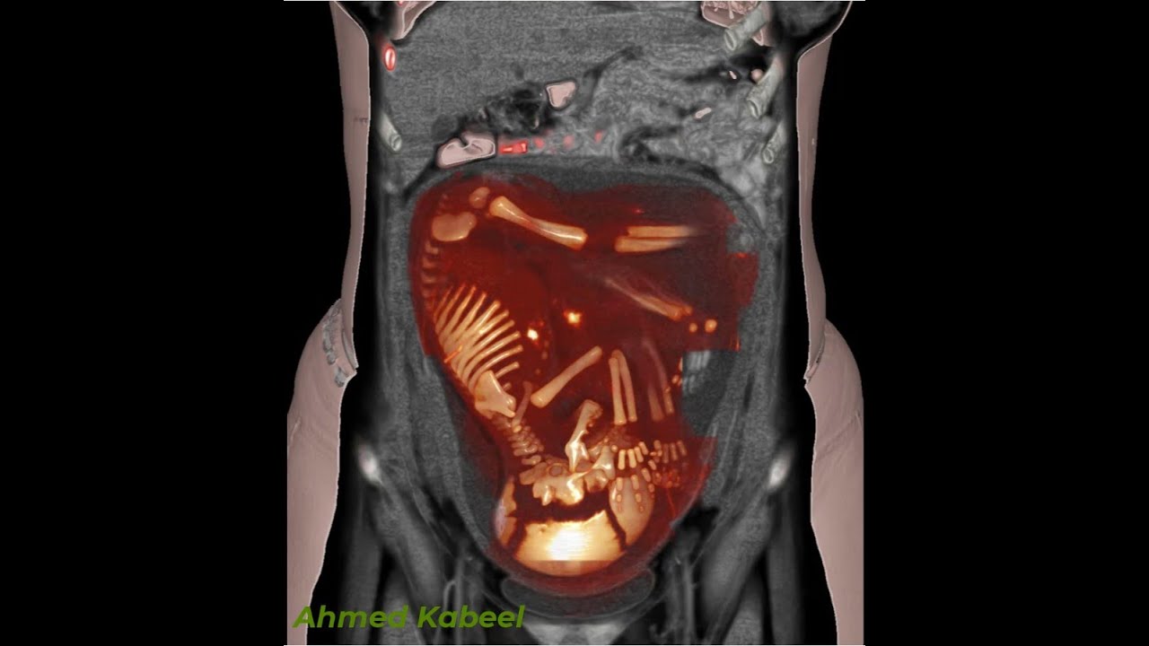 Pregnant CT & Fetal CT 3D by Synapse 3D - YouTube
