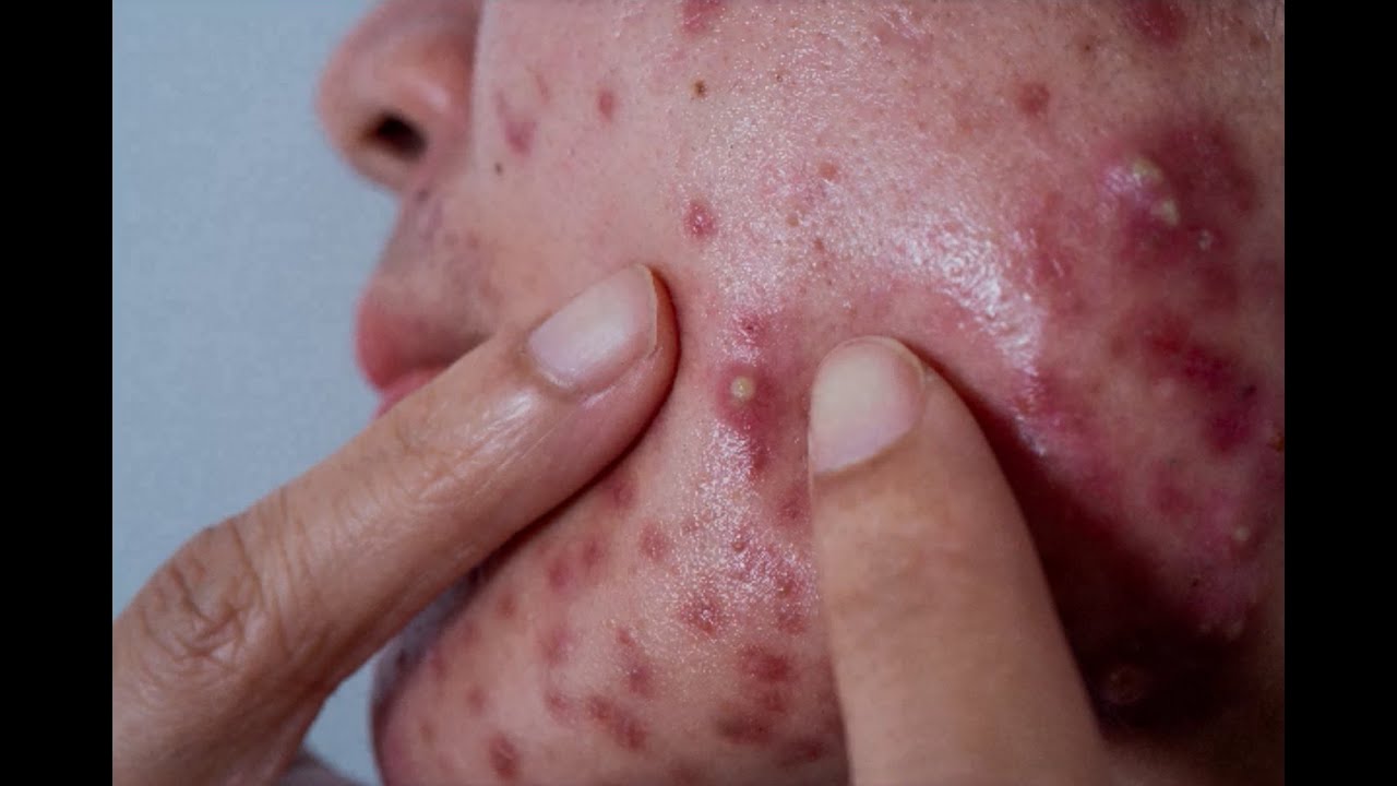 Here's the VA rating for Acne, Chloracne, Scarring alopecia, alopecia ...