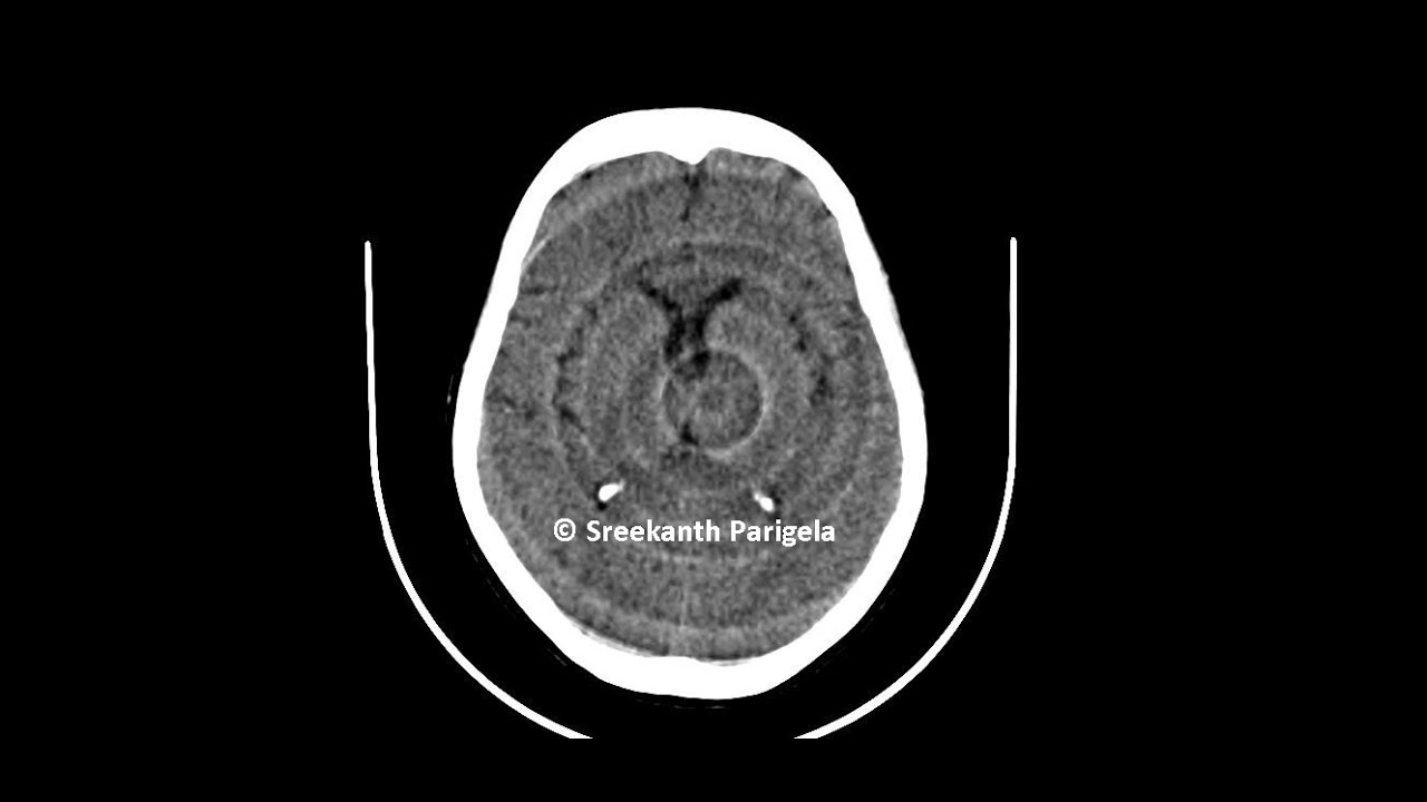 Ring artifacts - CT scan - YouTube