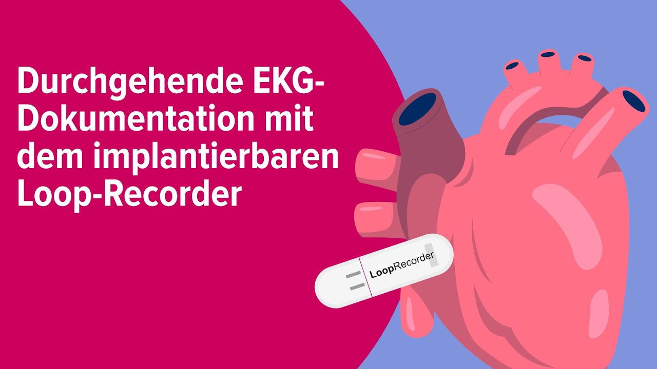 Durchgehende EKG-Dokumentation mit dem implantierbaren Loop-Recorder ...