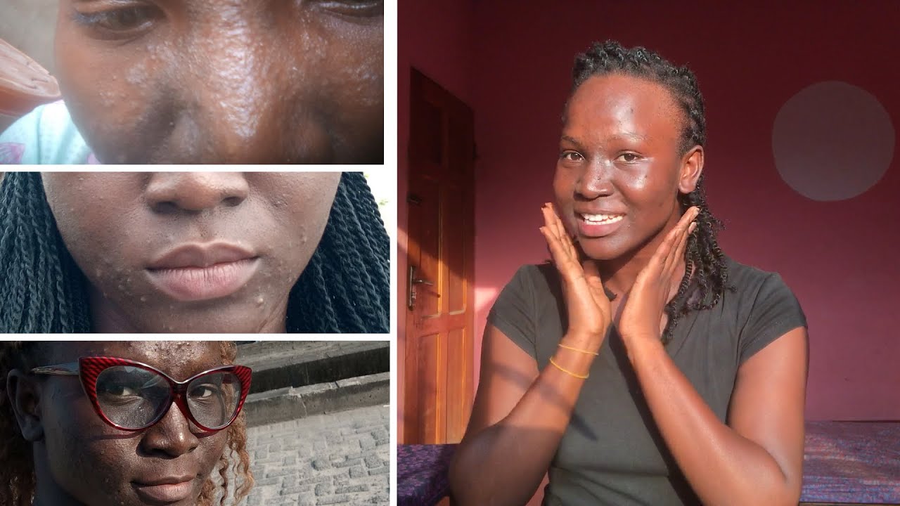 I Had Photodermatitis😱😰: My Journey into skincare routines (part 1 ...