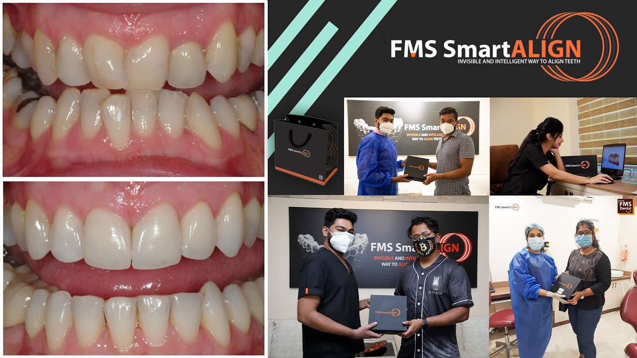 FMS SmartAlign | Designed and Delivered By Orthodontists |Aligners for Teeth correction| FMS ...