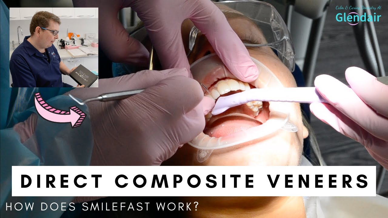 Direct Composite Veneers Procedure | Dentist Matt Explains SmileFast ...