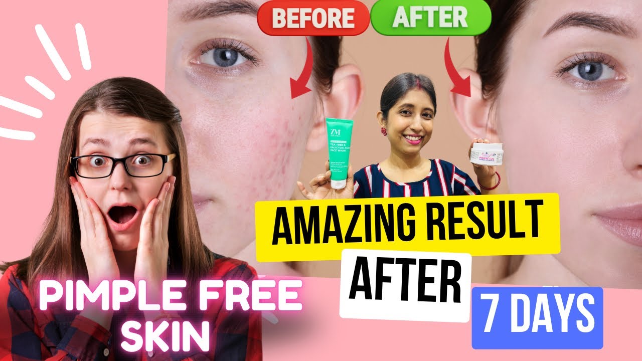 Pimple Free Skin 😍| Amazing Result After 7 Days 😳| Bloom Beauty Corner ...