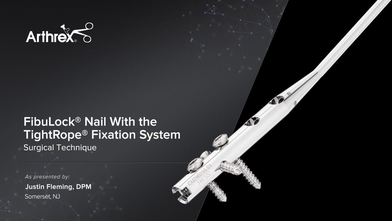 FibuLock® Nail With the TightRope® Fixation System - YouTube
