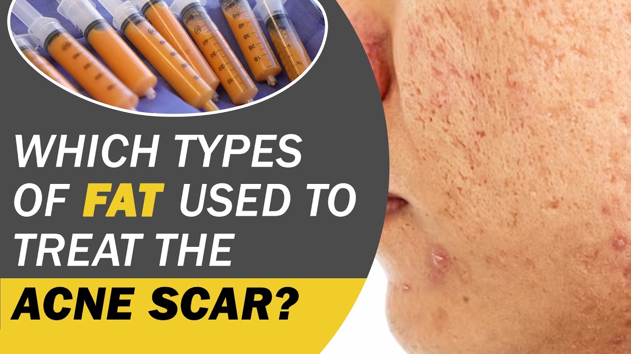 Which Type of Fat is Used for Fat Grafting? Acne Scar Treatment in ...