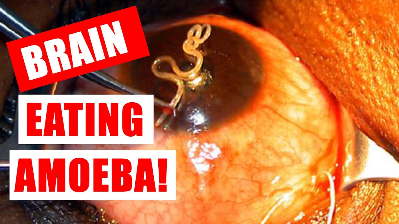 Brain Eating Amoeba Attacks Disney World in Orlando! - YouTube