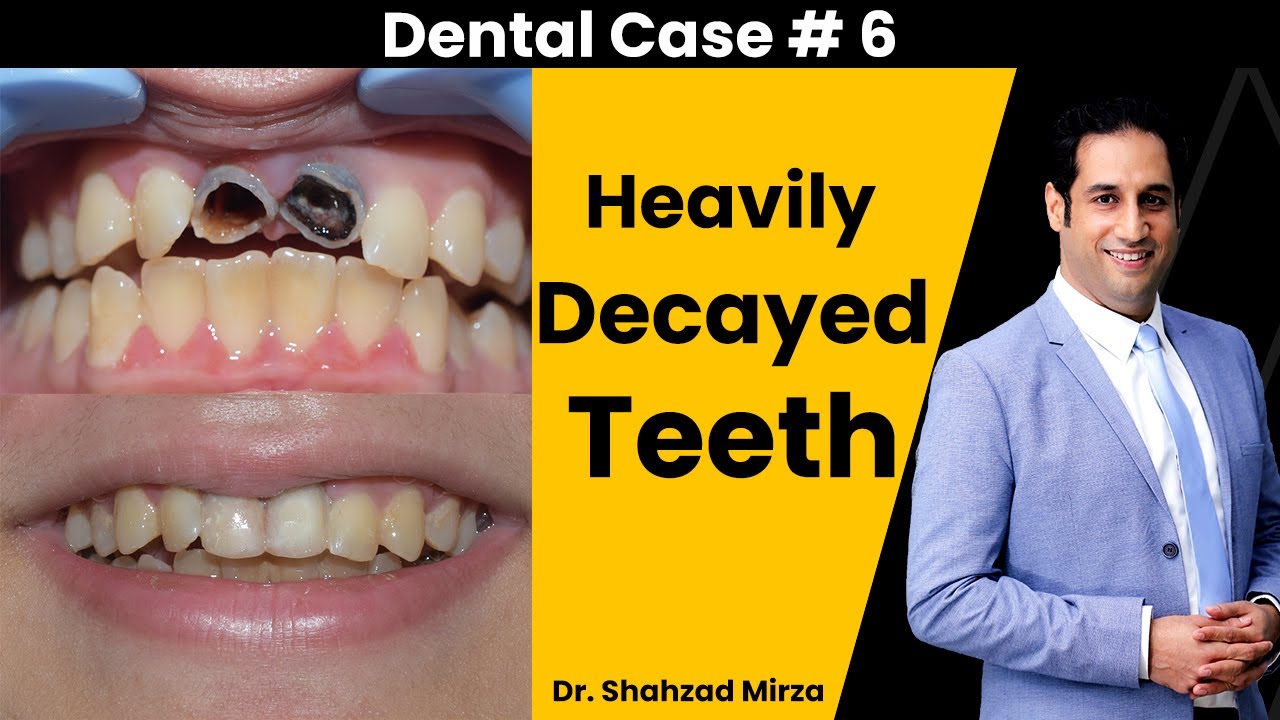 Minimal Invasive Dentistry For Saving The Heavily Decayed Teeth ...