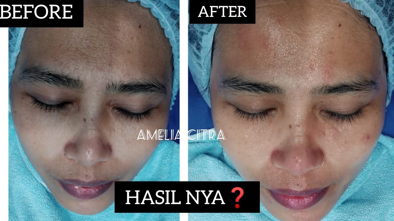 STRUGGLE BEFORE TREAT||FROZEN SKIN TREATMENT||FACIAL INSTAN GLOWING ...