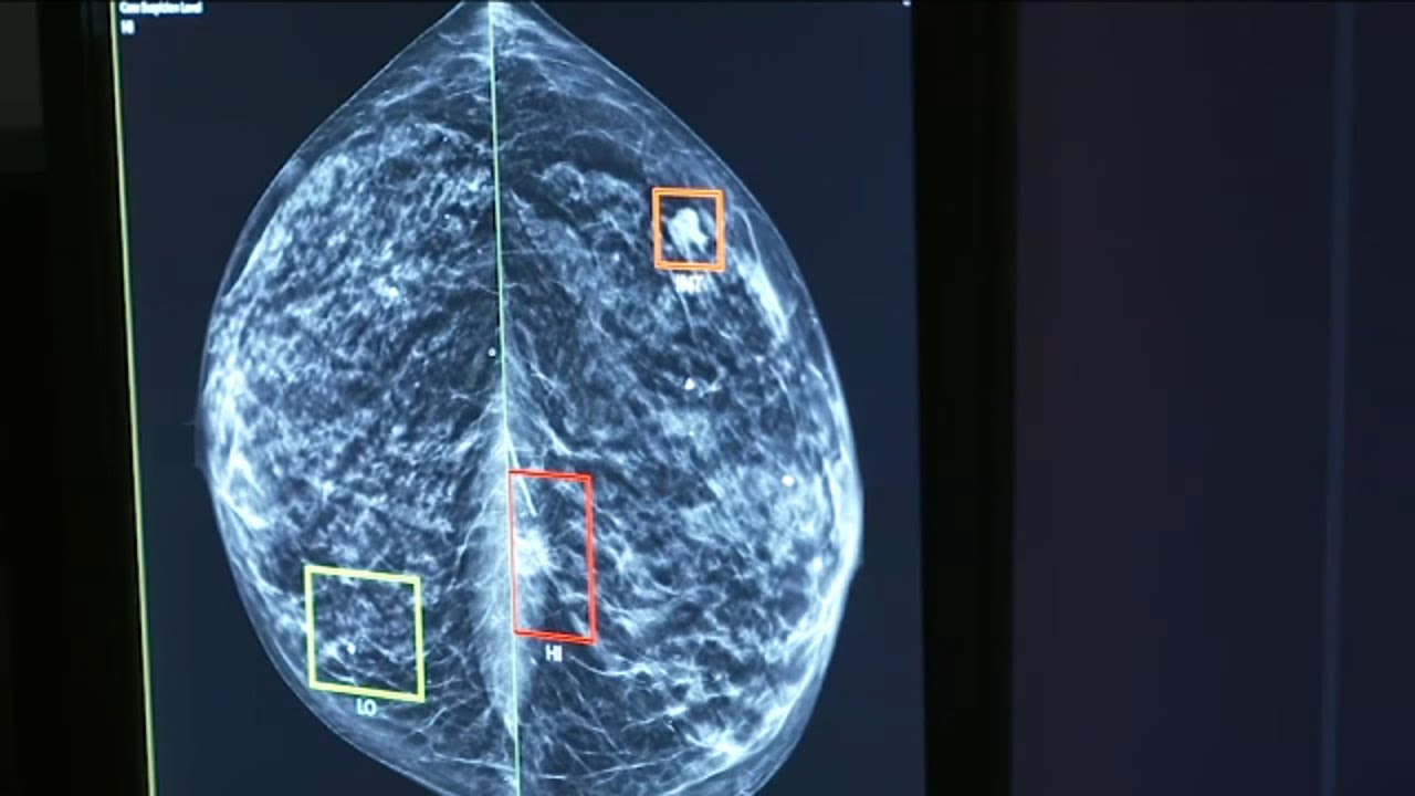 NYC hospital embracing AI to help detect breast cancer in mammograms ...