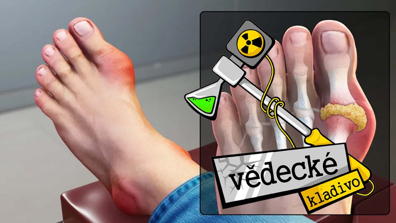 Co je to dna (královská nemoc)? - Vědecké kladivo AK 9 - YouTube