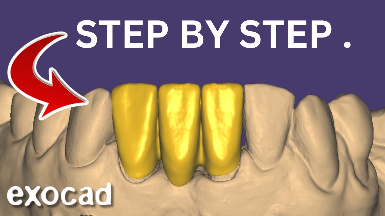 How to Make ANTERIOR Bridge look NATURAL. EXOCAD - YouTube