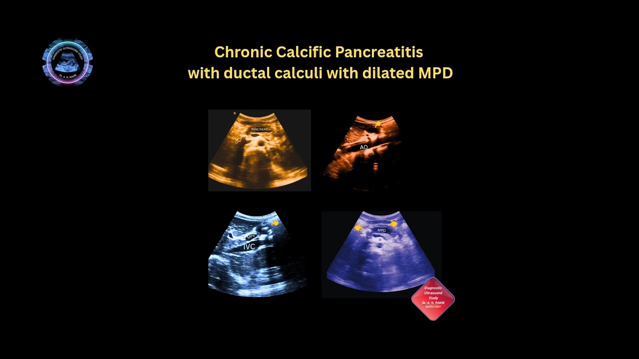 Chronic Calcific Pancreatitis with Intraductal Calculi | Ultrasound ...