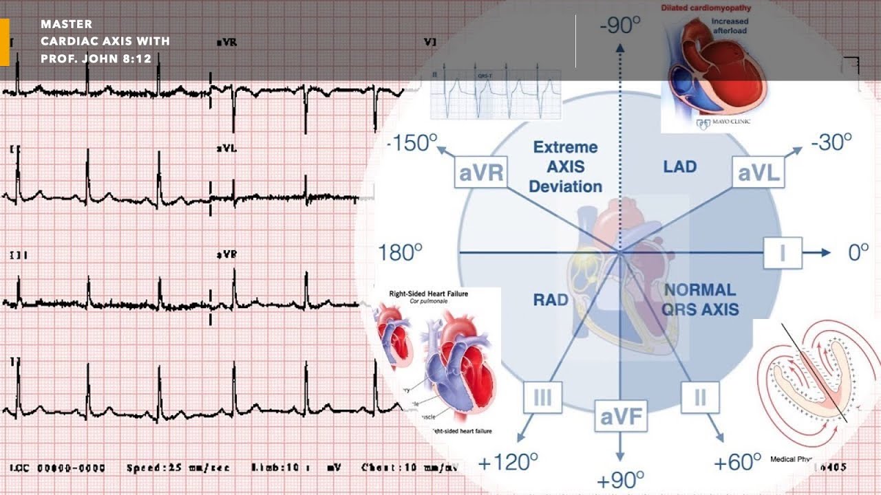 Normal Avf Ecg Tracing