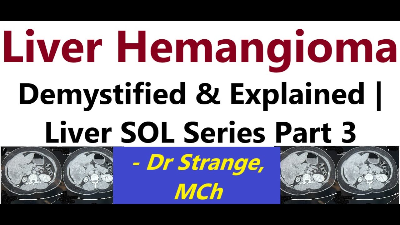 Liver Hemangiomas (Part-1 YT): Demystified & Explained | Liver SOL Series Part 3. #hemangioma ...