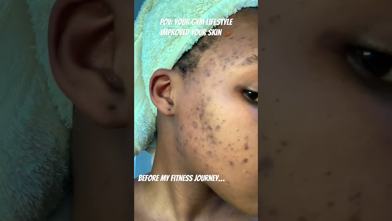 Breaking Out of Acne: How My Gym Lifestyle Became My Skincare Secret 🏋️ ...