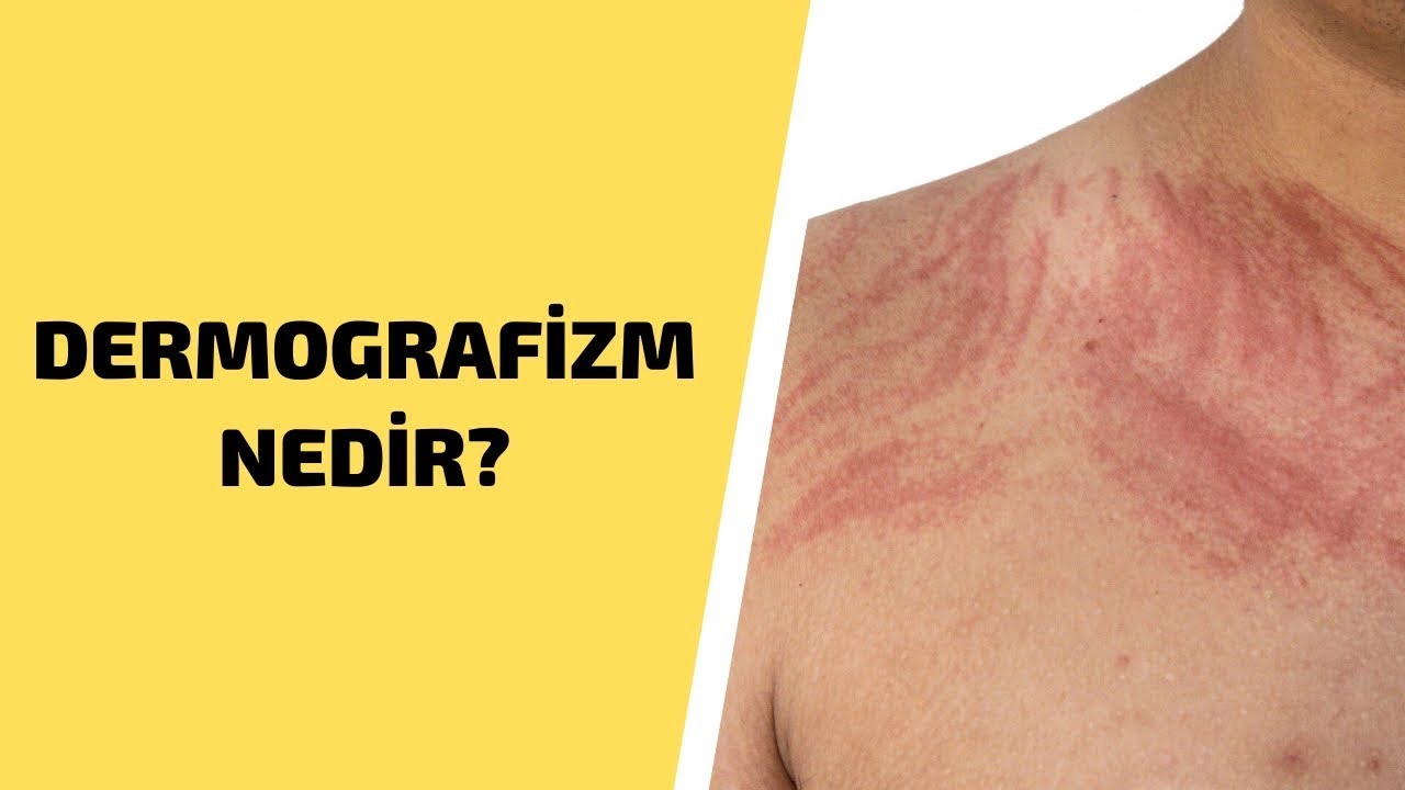 Dermografizm Nedir? Belirtileri Nedir? Dermografizme Ne İyi Gelir ...