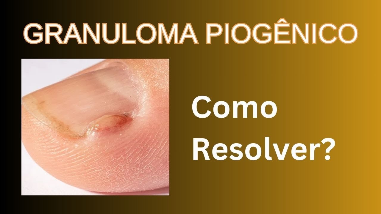 Granuloma Piogênico (carne esponjosa). Como Resolver? Nas UPAs se faz ...