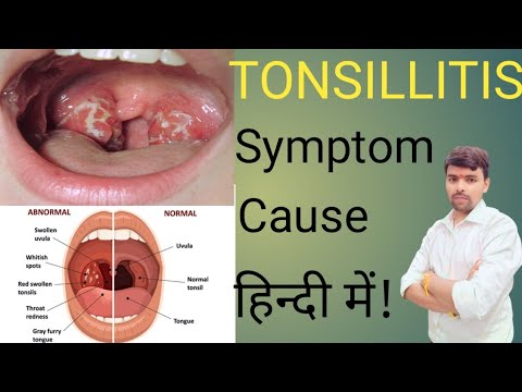 Tonsil keya hota hai?Tonsillitis keya hota hai?symptom of tonsillitis ...