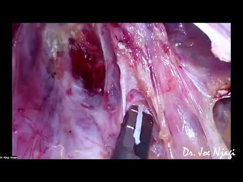 Radical Hysterectomy
