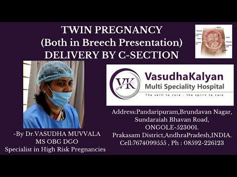 TWIN PREGNANCY (Both in Breech Presentation)-Delivery by C-section -By Dr VASUDHA MUVVALA MS OBG ...