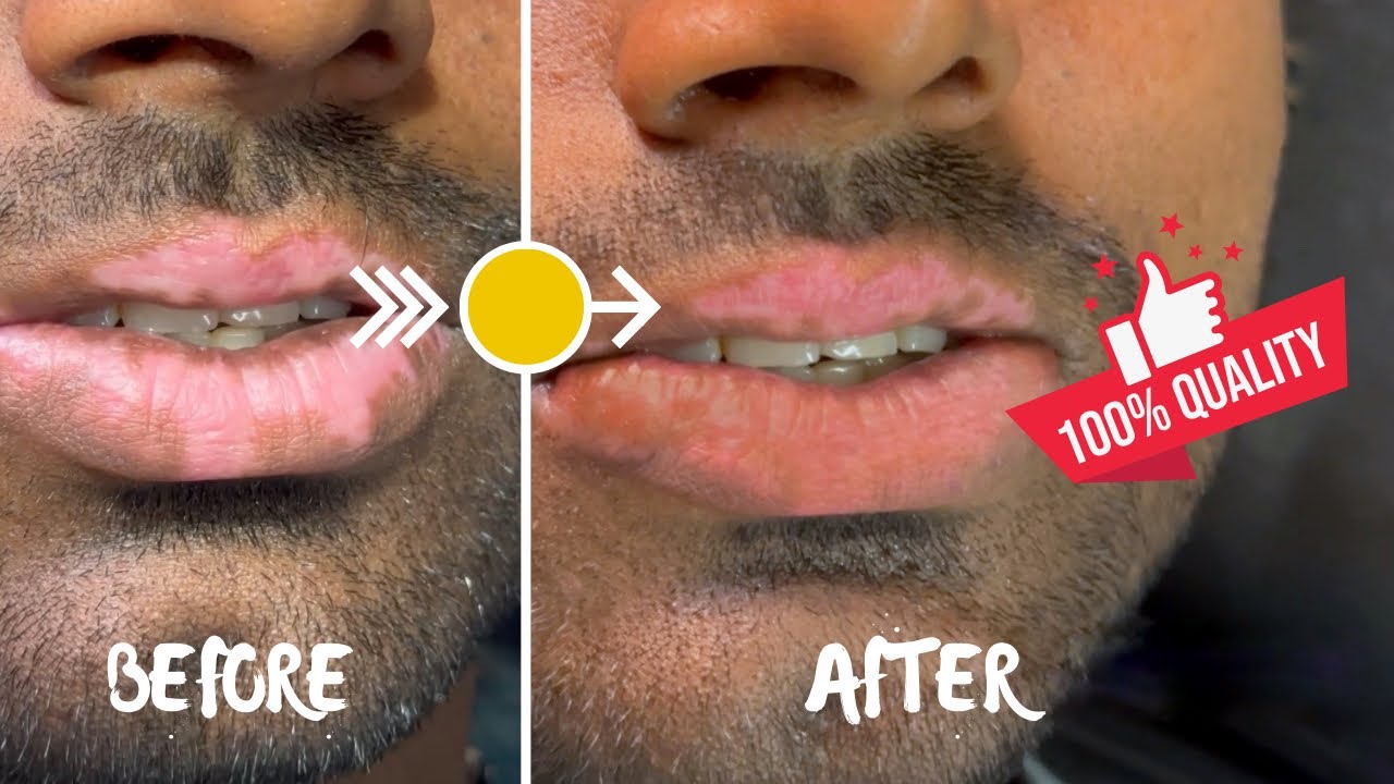 Vitiligo White patch lips treatment | 100% Results | Machu Tattoos ...
