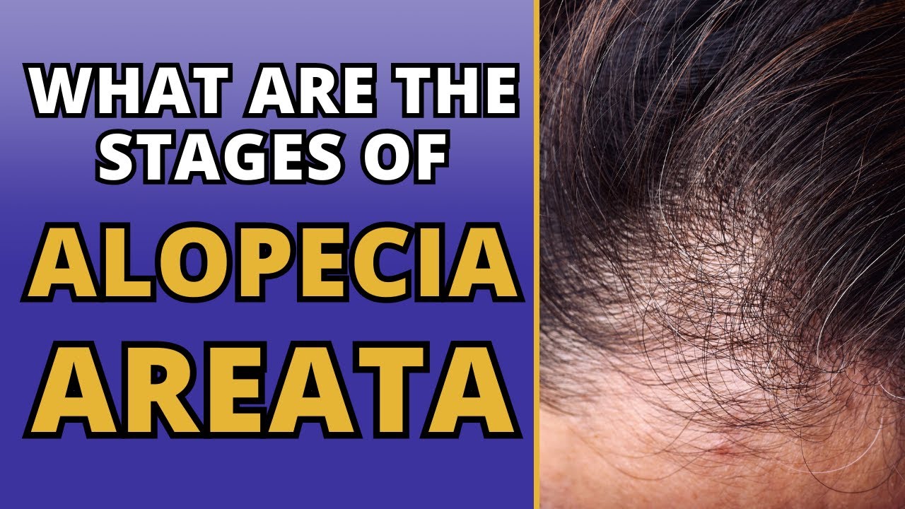 Understanding the Different Stages of Alopecia Areata in Females - YouTube