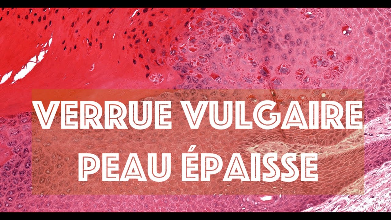 LA VERRUE VULGAIRE (peau épaisse) - PATHOLOGIE - YouTube