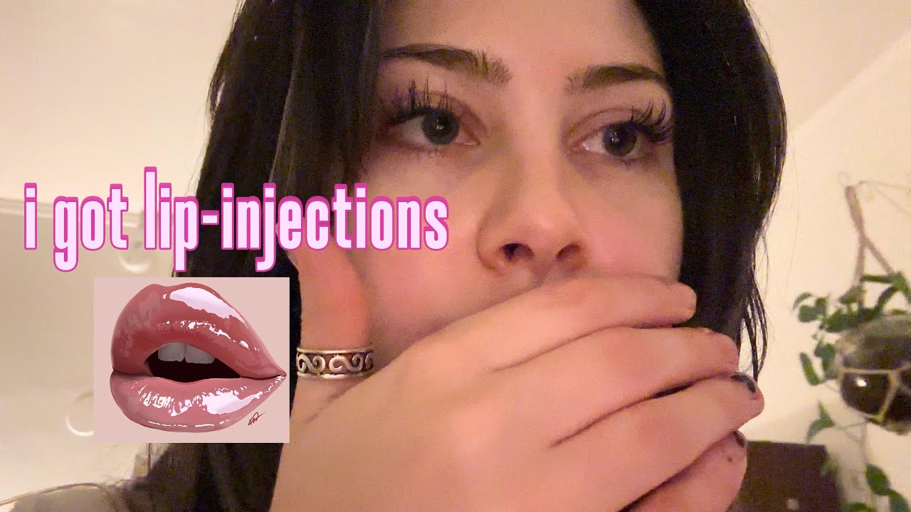 Vlog #7 I got Lip Injections n Everyone in LA is ugly - YouTube