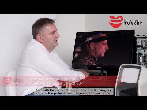 Rhinoplasty  - Dr. Irfan Aydin - Luna Health Turkey
