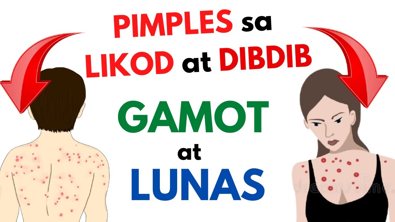 Paano mawala ang PIMPLES sa LIKOD, DIBDIB, Braso? Tigyawat sa LIKOD ...