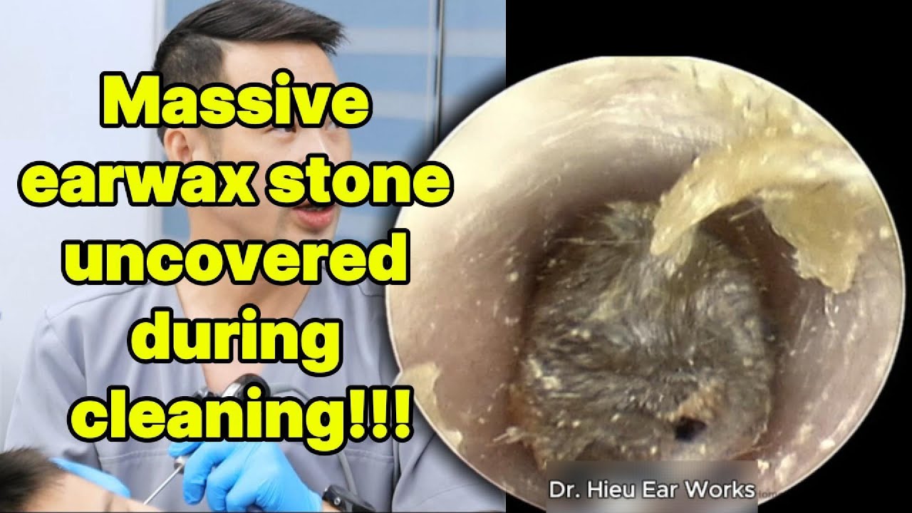 Massive earwax stone uncovered during cleaning | ear cleaning | ASMR ...