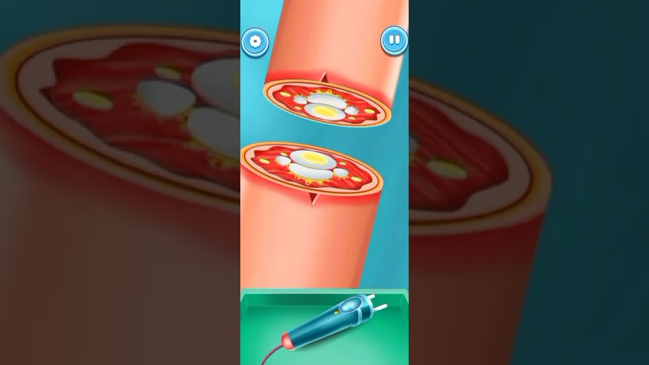 Replantation is the surgical reattachment of a finger. - YouTube