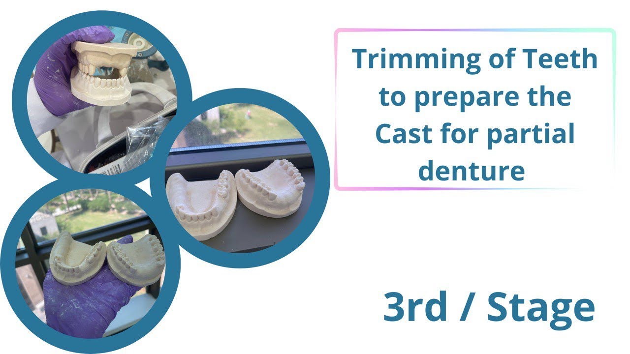Trimming of teeth to prepare the upper and lower Cast for partial ...
