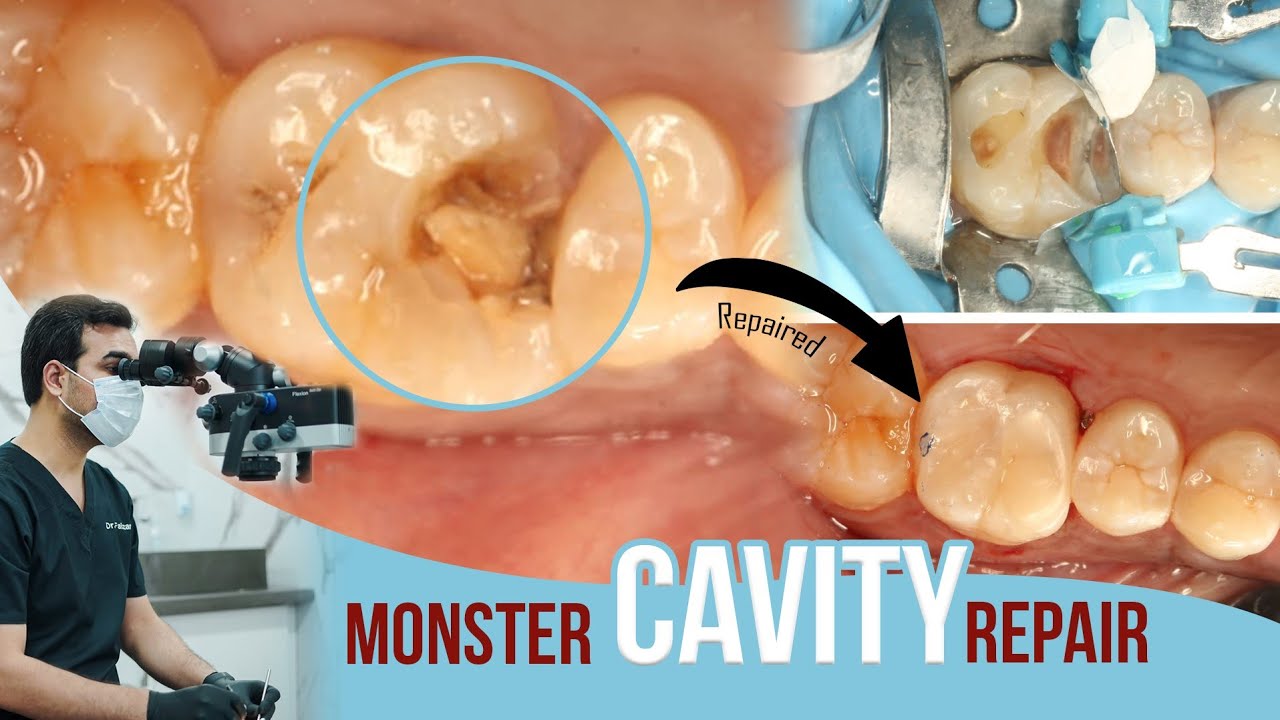 Monster TOOTH cavity repair 🤩 #4k #dentist #satisfying #dentistry - YouTube