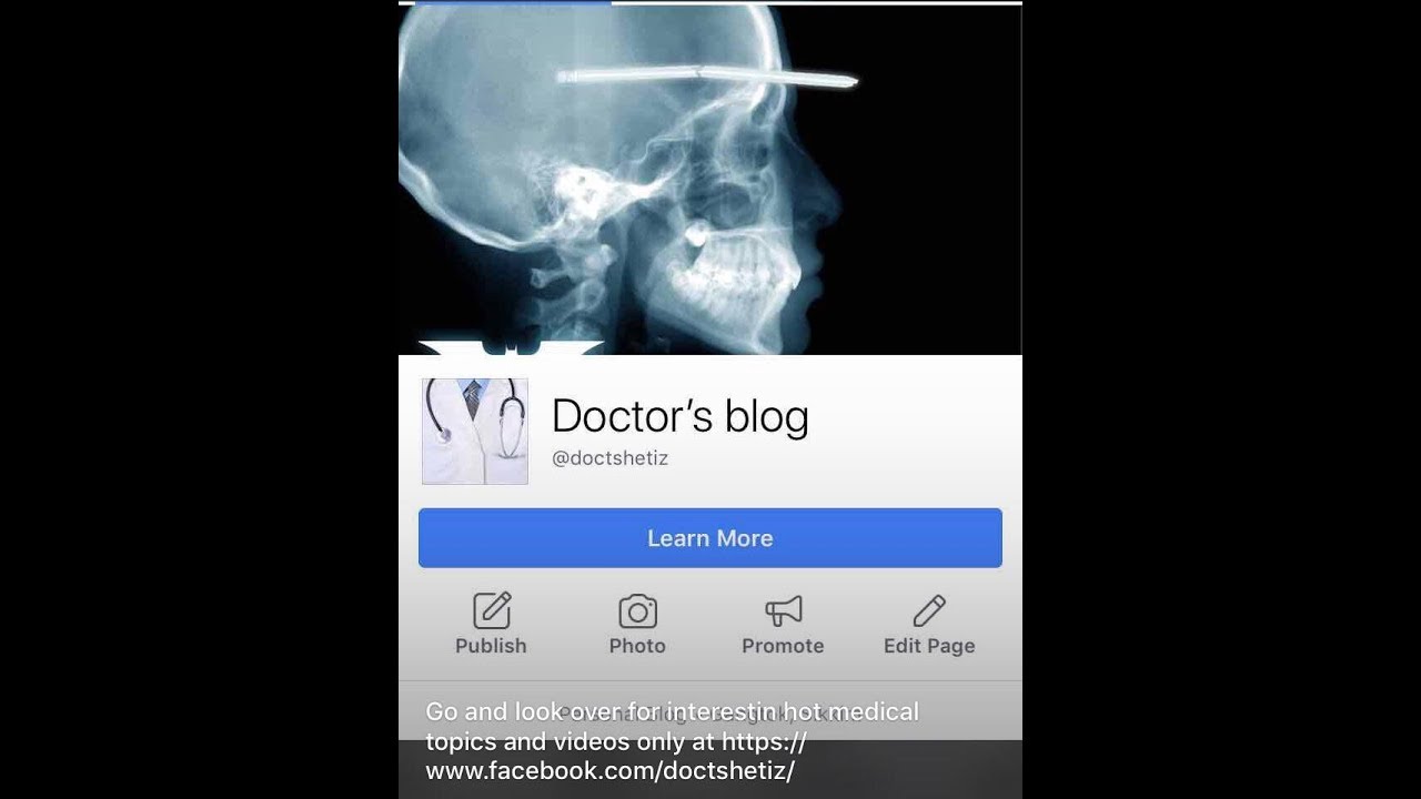 BRAIN OR INTRACRANIAL ANEURYSM SURGICAL CLIPPING - YouTube