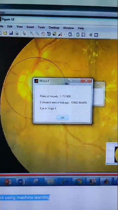 DREAM: diabetic retinopathy analysis using machine learning - YouTube