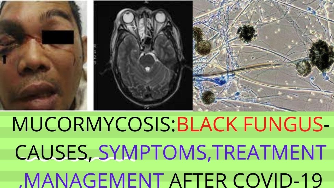 MUCORMYCOSIS( Black fungus) -causes, symptoms, treatment after covid ...