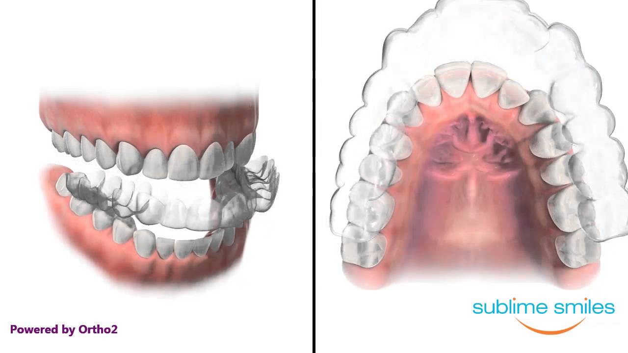 Invisalign/Clear Removable Appliance - YouTube