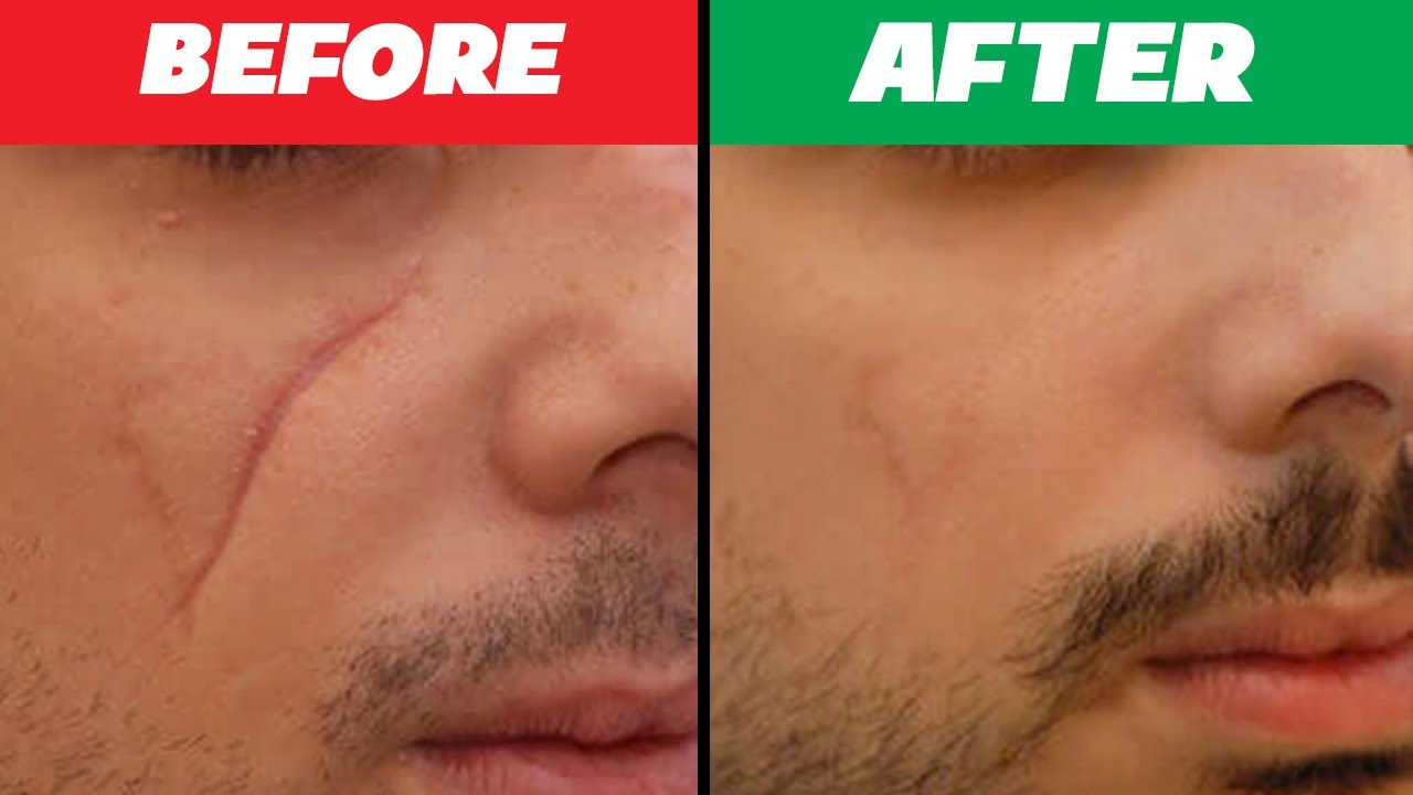 Scar Revision Treatment without surgery at home /naturally/ - YouTube
