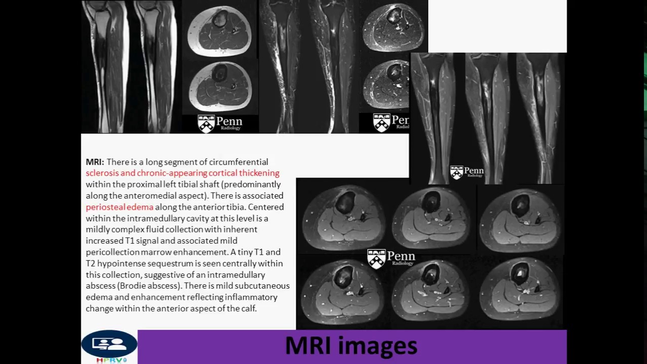 Brodie abscess, subacute osteomyelitis - YouTube
