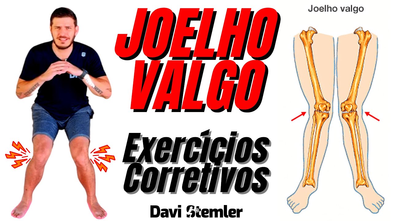 JOELHO VALGO - EXERCÍCIOS CORRETIVOS (PREVENÇÃO DE LESÃO DE LCA) - Davi ...