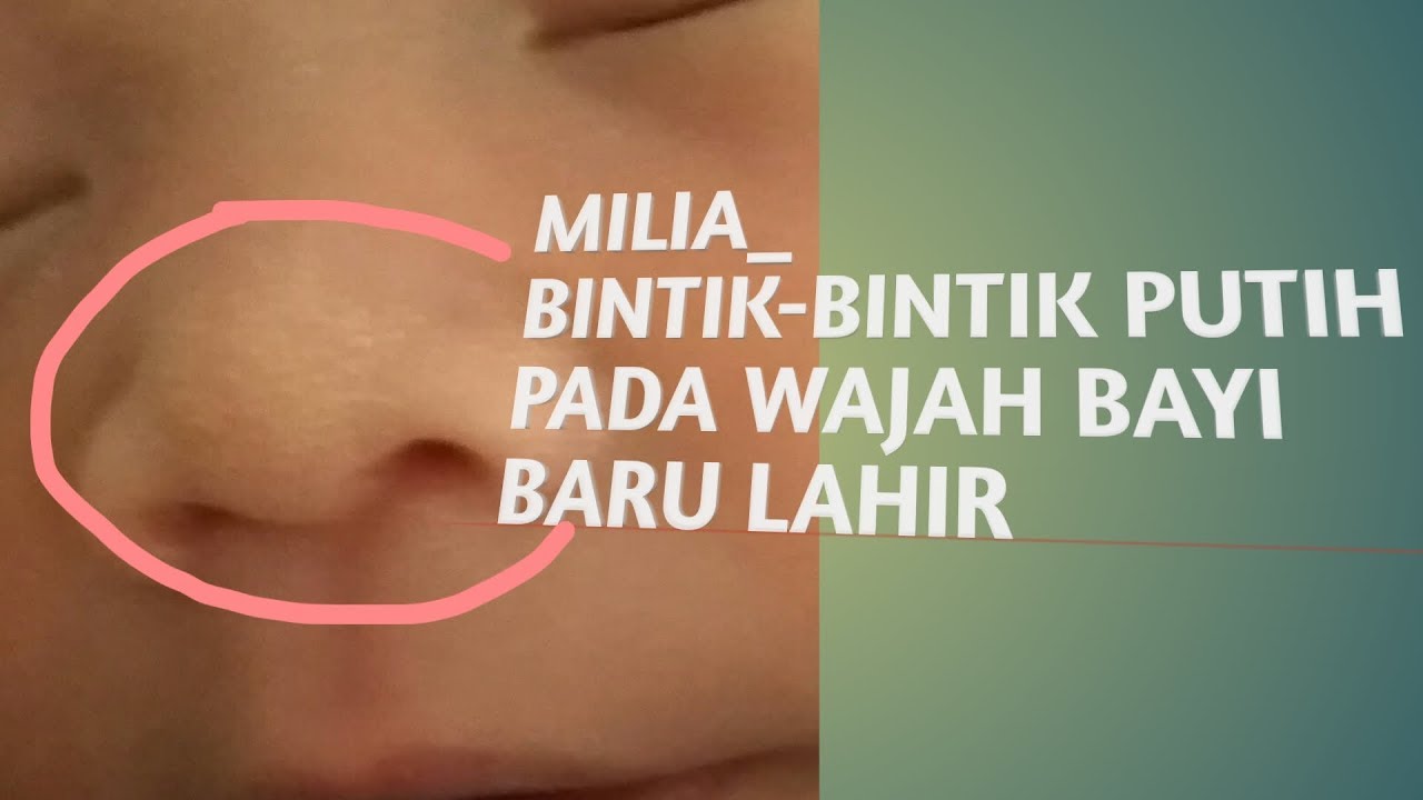 MILIA, BINTIK PUTIH PADA WAJAH BAYI BARU LAHIR DAN PENANGANANNYA - YouTube