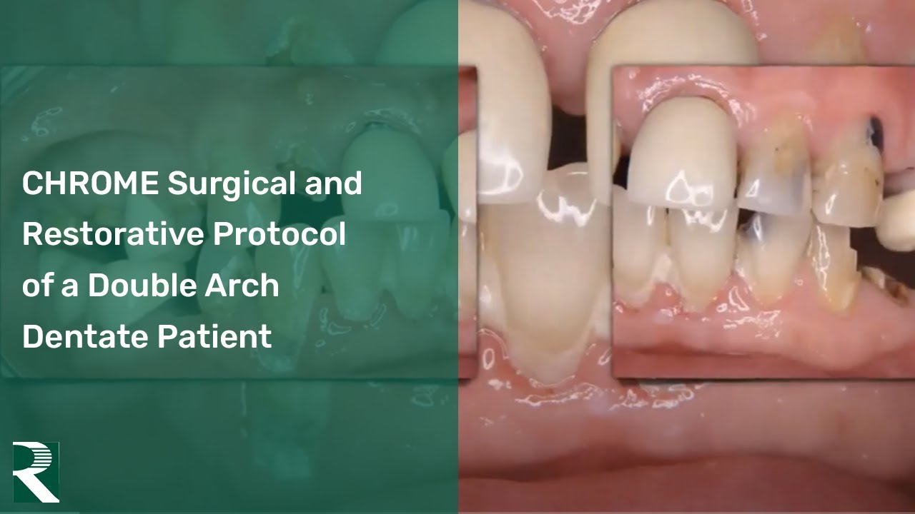 CHROME Surgical and Restorative protocol of a double arch dentate ...