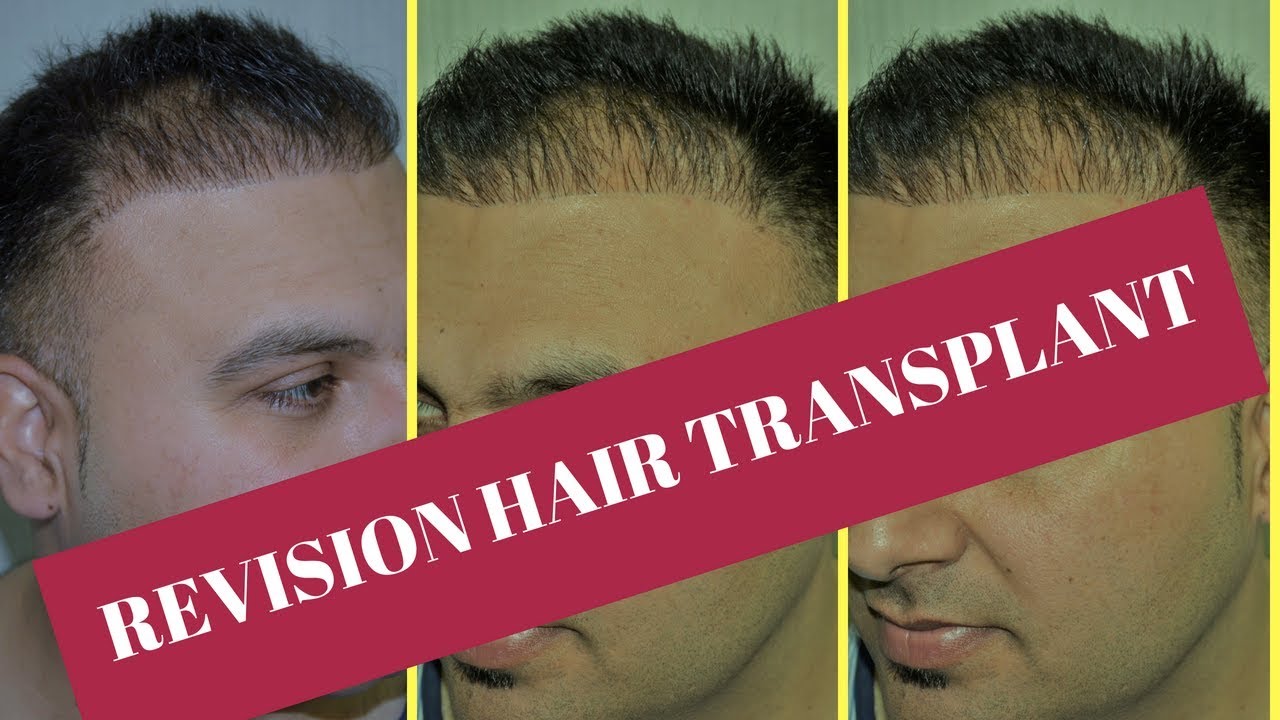 Bad Hair Transplant Revision in India - YouTube