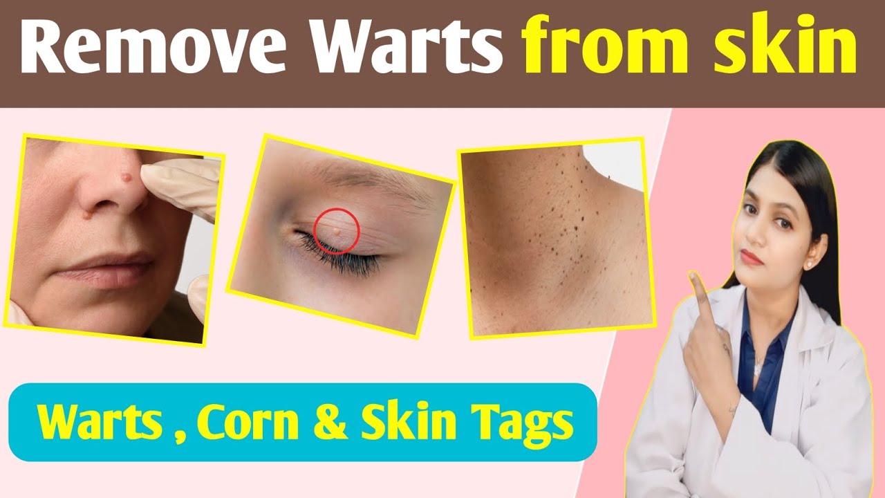 warts homeopathy medicine | warts removal on face | warts ,Corn , skin ...