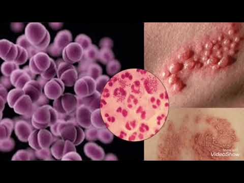 JINSIY AZODAN TOSHMA TOSHSA DAVOLASH(FAQAT AYOLLAR KURSIN)