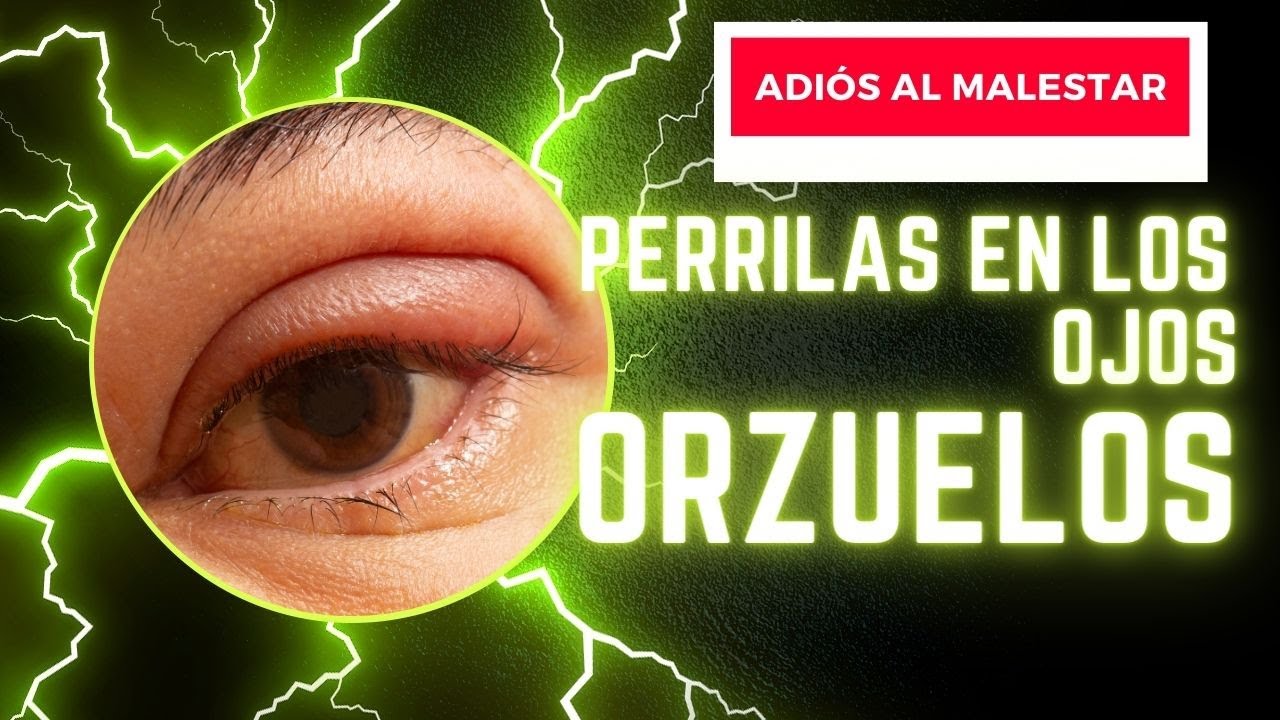 Orzuelos y Perrillas en los Ojos: Adiós al malestar - Jue-Ves - Dra ...